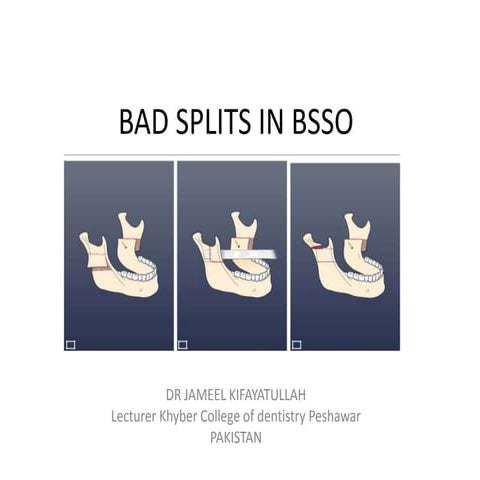 Bad splits in bsso | PPTX