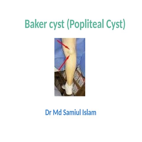 Bakers cyst-Recent Thought for the management.pptx