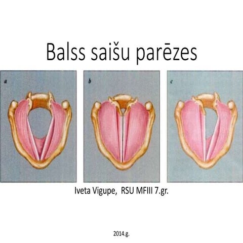Balss saišu parēzes | PPTX