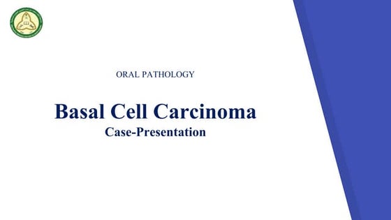 Basal cell carcinoma | PPTX