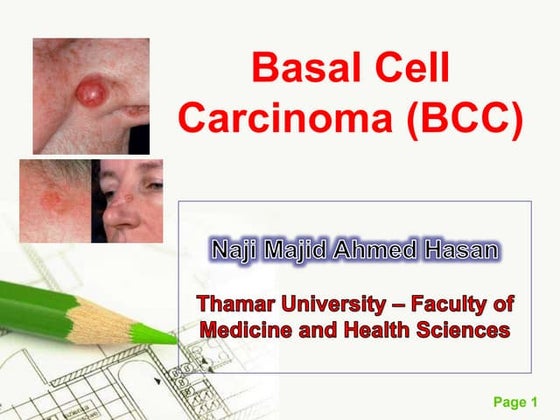 Basal cell carcinoma | PPTX