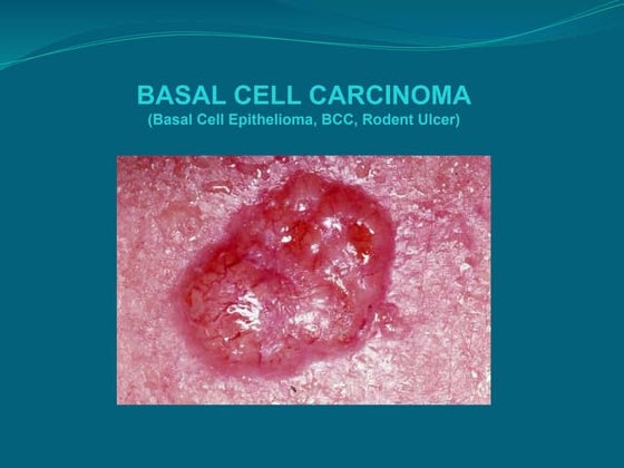 Oral Basal Cell Carcinoma Dental Update Skin Cancer And Some Common