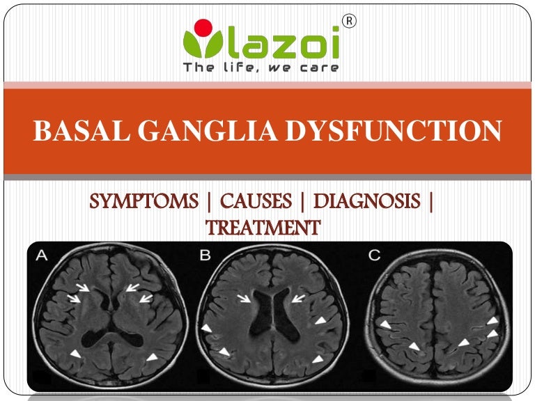 Basal Ganglia Disease Causes Symptoms Treatment And Diagnosis