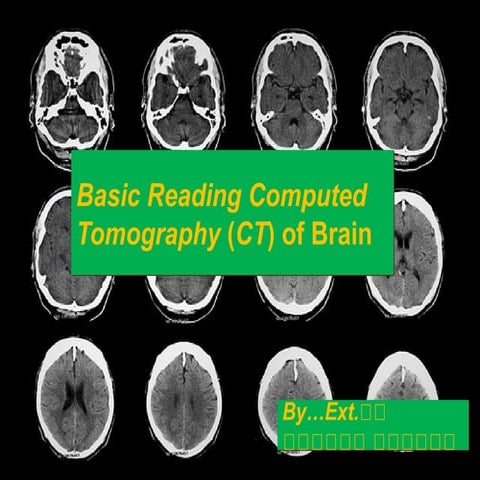 Basic Reading CT Brain.. | PPT
