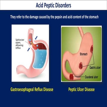 Basics of GERD, peptic Ulcer & Gastroparesis | PPTX