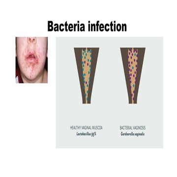 Baterial infection related to ............ | PPT