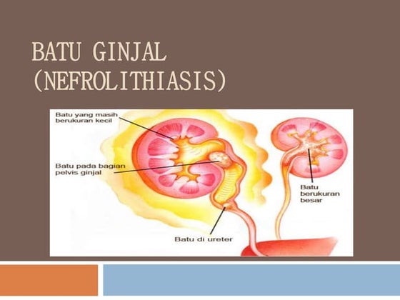 405821839 nefrolithiasis-pptx | PPT