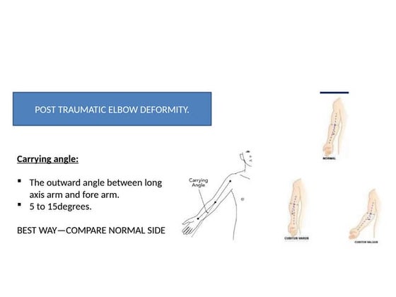 Cubitus varus and valgus | PPT