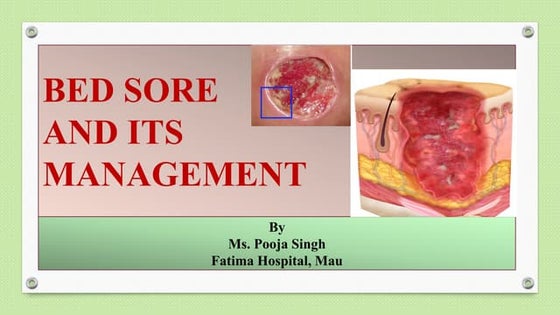 Pressure sore or bed sore or decubitus ulcer ppt | PPT