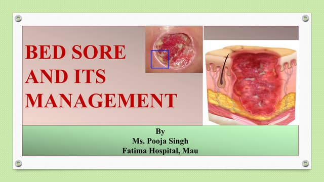 Bed Sore Ppt