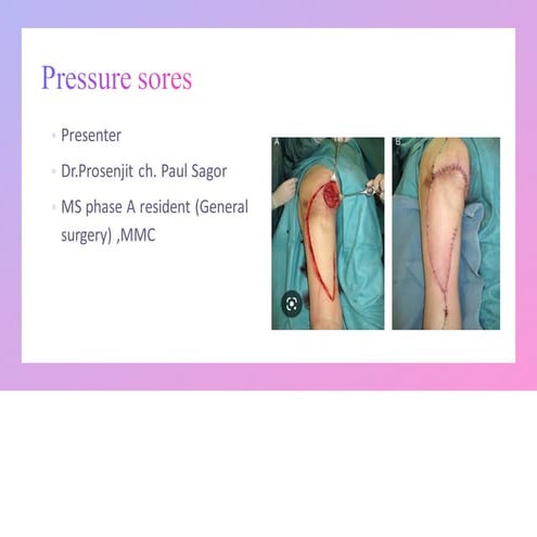 Bed sore.pdf