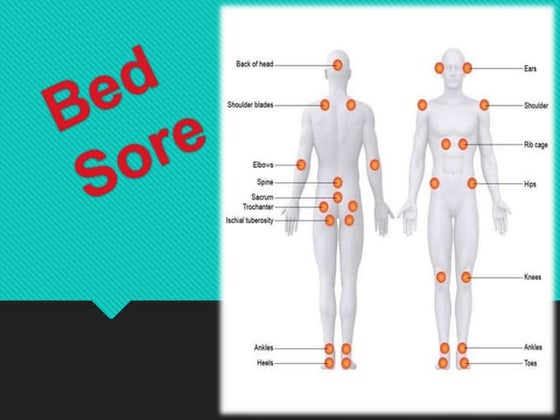 Pressure sore or bed sore or decubitus ulcer ppt | PPT
