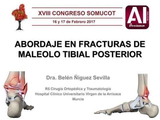 Maleolo Posterior The Radiology Assistant : Special Ankle Fractures