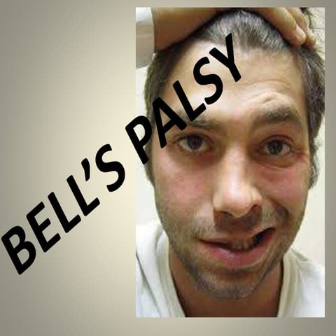 Bells palsy | PPTX