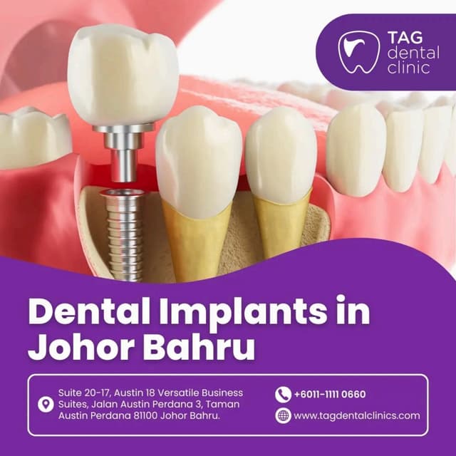 Benefits of Dental Implants at TAG Dental Clinic in Johor Bahru | PDF