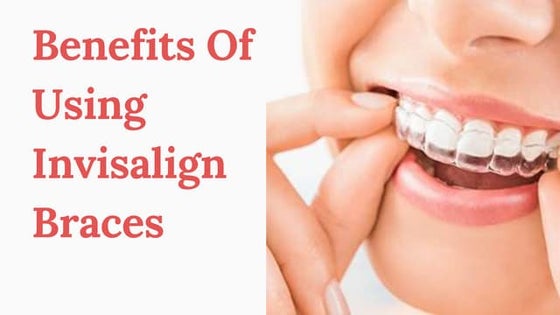 Invisalign FAQS | PPT