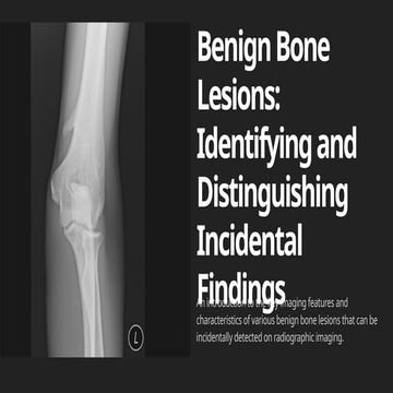 Benign Bone Lesions Identifying and Distinguishing Incidental Findings.pptx