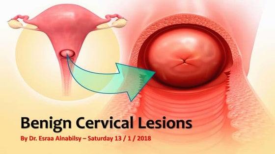 Cervical erosion | PPTX