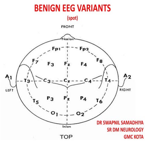 Abnormal EEG patterns