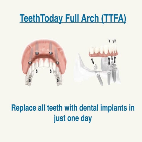 TTFA - TeethToday Full Arch - Abaden Dental Group | PPT