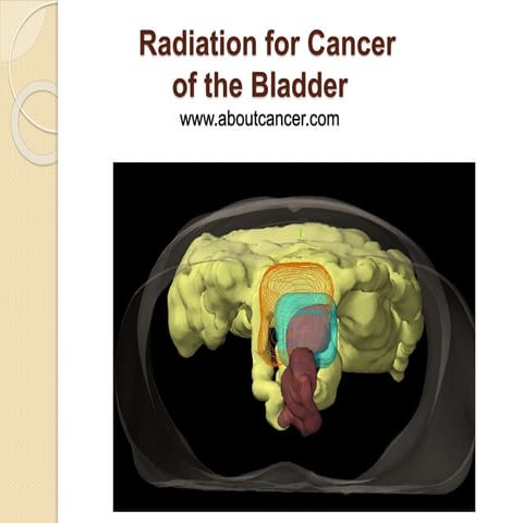 Radiation for the Treatment of Bladder Cancer | PPTX
