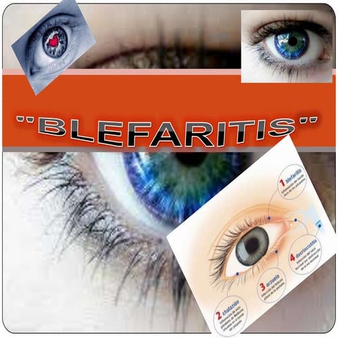 Blefaritis | PPTX