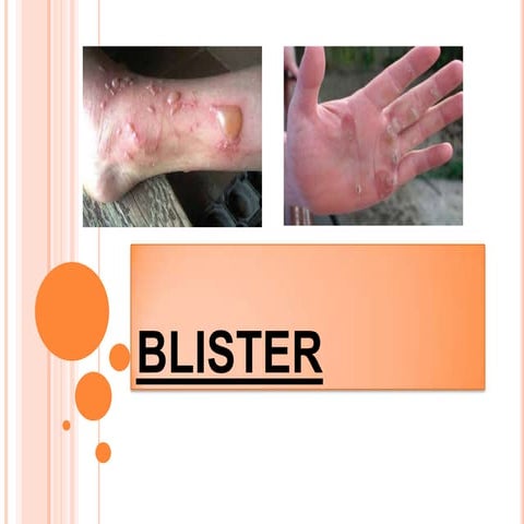 Blister first aid | PPTX