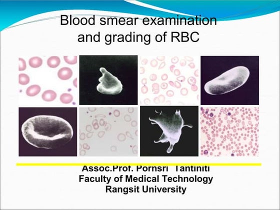 Abnormal morphology of rbc notes | PDF