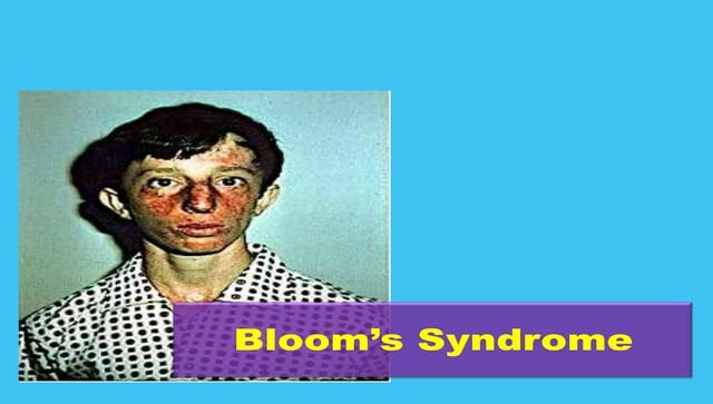 Bloom Syndrome