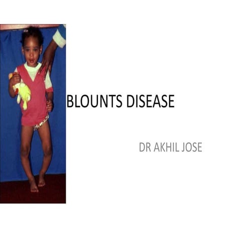 blounts disease.pptx