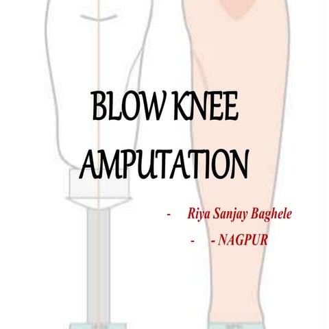 Blow knee amputation 1 | PPTX