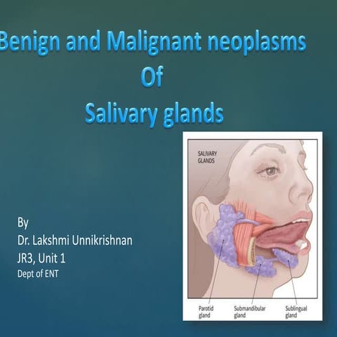 Salivary gland neoplasms | PPTX