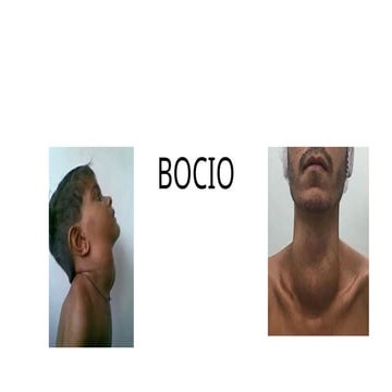 Bocio y enfermedad tiroidea nodular | PPTX