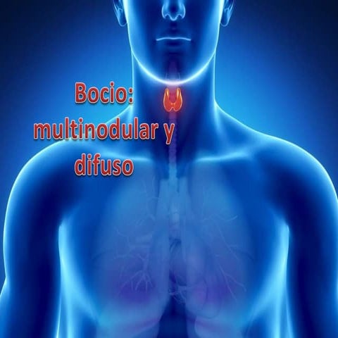 Bocio multinodular y difuso | PPTX