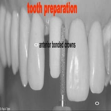 Tooth Preparation - Anterior bonded crowns | PDF