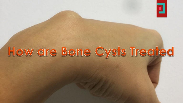 How are Bone Cysts Treated