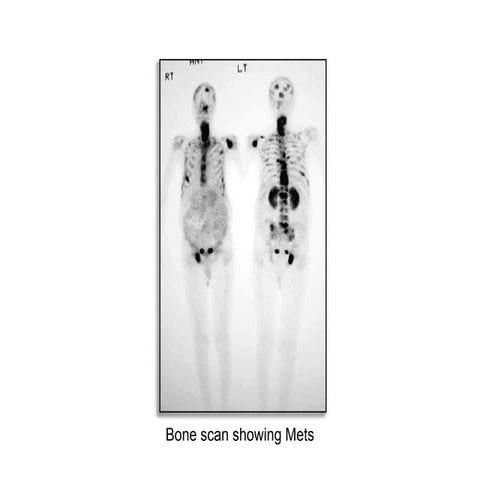 Bone Scan | PPT