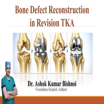 Bone Defect Reconstruction in Revision TKA – Dr Ashok Bishnoi, Joint ...