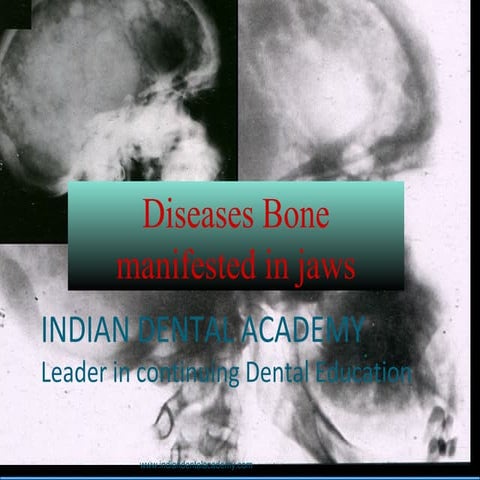 Bone disorders / certified fixed orthodontic courses by Indian dental ...