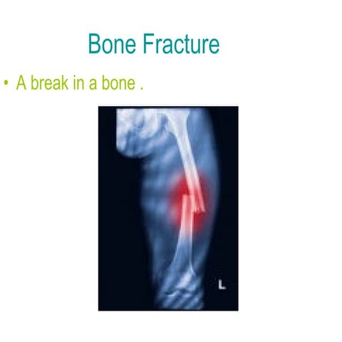Bone fracture | PPT