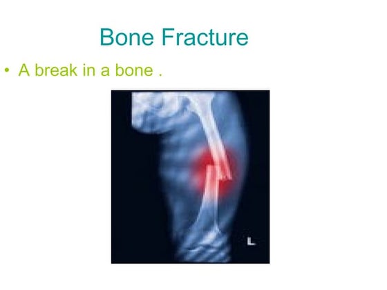 Bone Fractures | PPT