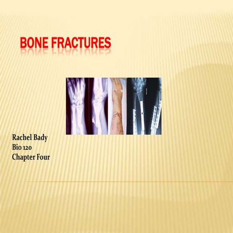 Bone Fractures | PPT