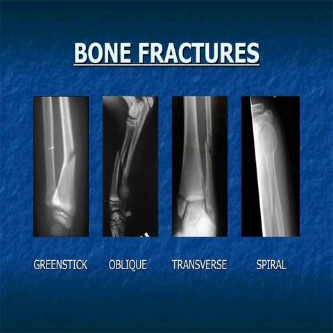 Bone fractures | PPT