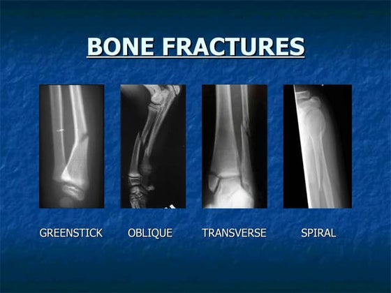 Transverse fracture presentation bio 120 | PPT