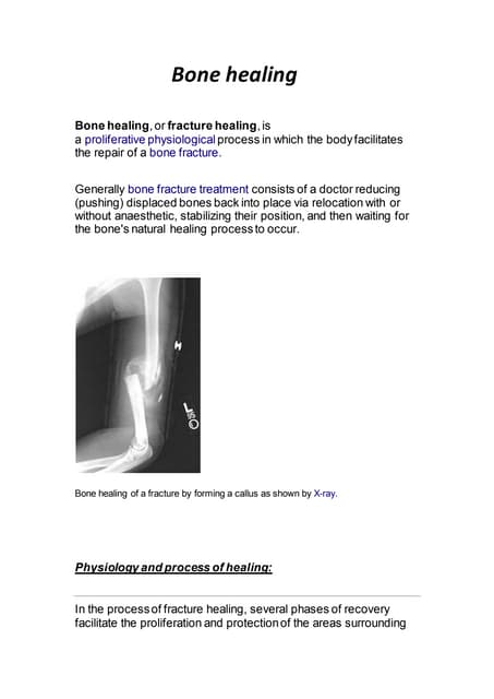 Fracture healing | PPT