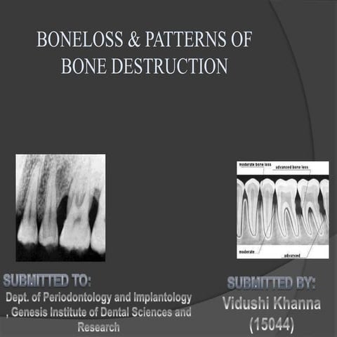 Patterns of bone destruction in periodontics | PPTX