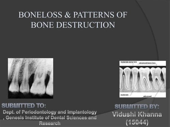 Patterns of bone destruction in periodontics | PPTX