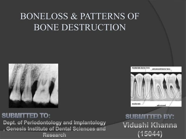 BONE DEFECTS lecture in periodontology. | PPTX