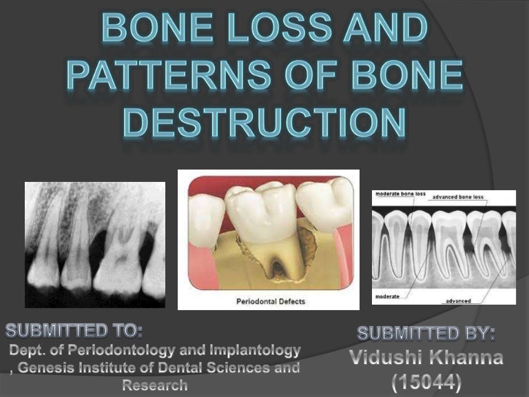Bone loss and patterns of bone destruction
