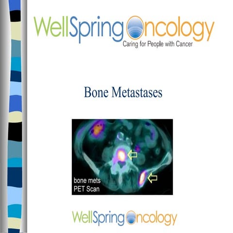 Bone Metastases | PPT